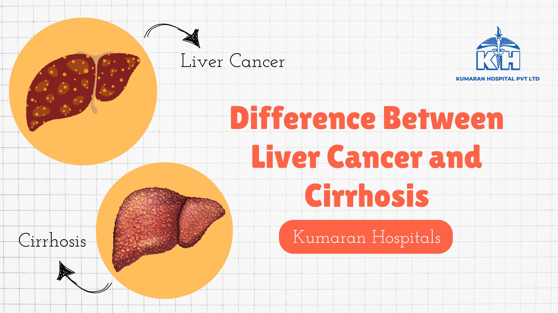 Understanding the Difference Between Liver Cancer and Cirrhosis ...